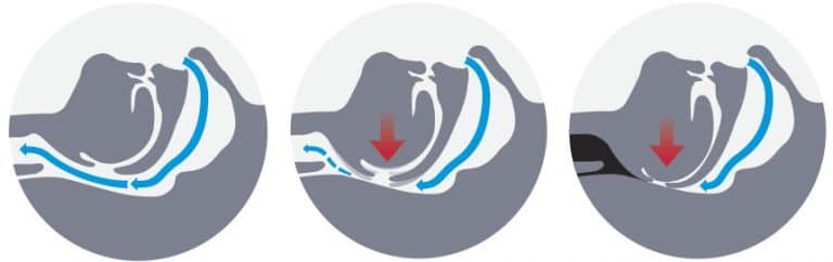 Apnea del sueño - TerapiaCPAP